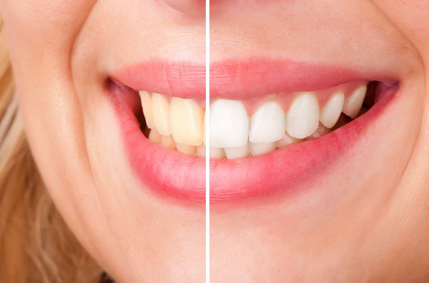 Best Way to Whiten Teeth | Schmakel Smile Design | Toledo, OH Best Way to Whiten Teeth | Schmakel Smile Design | Toledo, OH